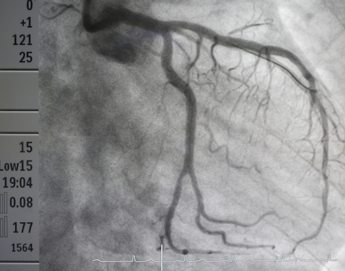 Coronary Artery Disease Treatment | Cypress Cardiologists