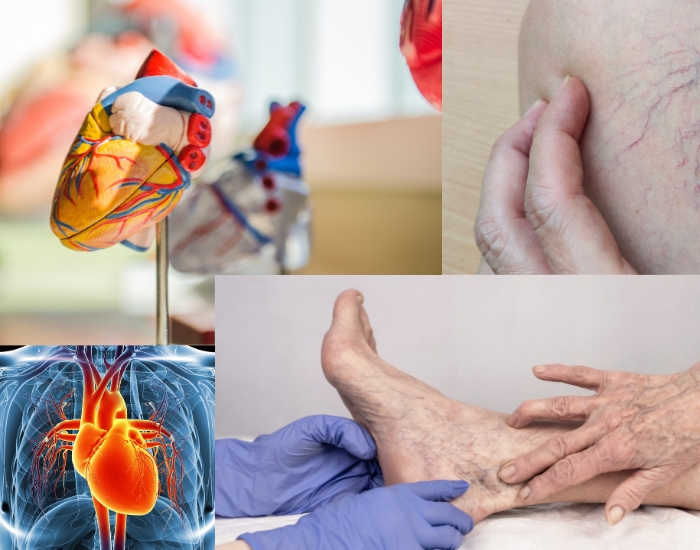 Peripheral Arterial Disease | Symptoms, Tests & Treatment Options